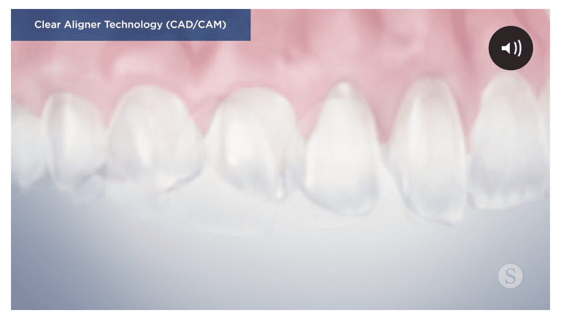 Aligner Therapy - Dental Arts on Essex